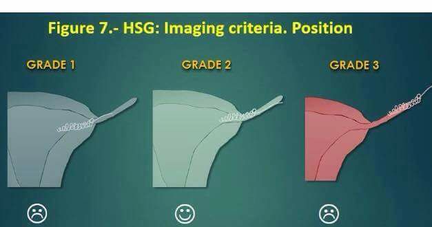 Help - Essure Problems